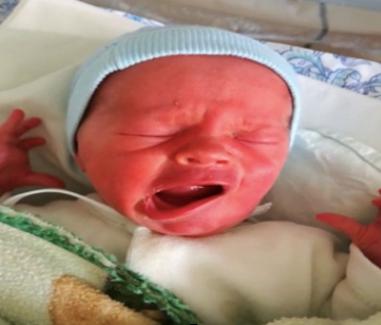 Two newborns with crooked mouths | ADC Education & Practice Edition