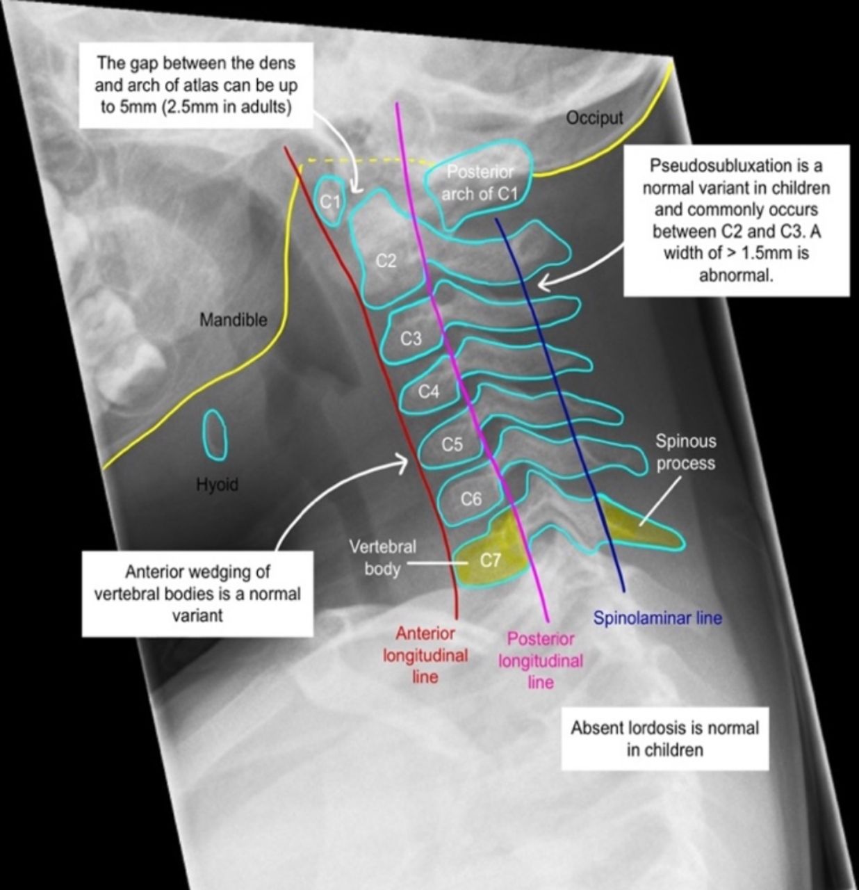 How to interpret spinal imaging in paediatric trauma | ADC Education ...